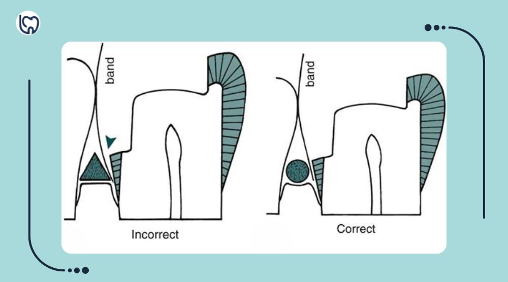 The Secrets to Achieving Tight Contact in Composite Restorations: Your ...