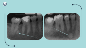 Enostosis (Dense Bony Island): Radiographic Features & Significance ...