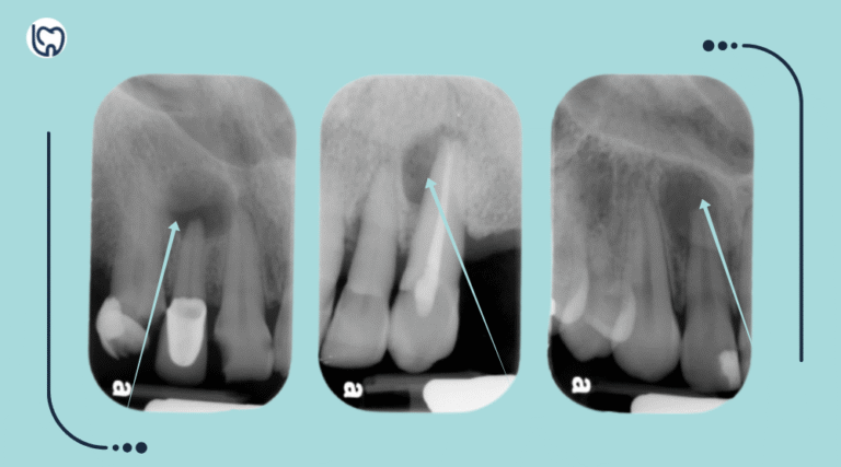 Rarefying Osteitis: Radiographic Signs of Periapical Inflammation - Dr LOD