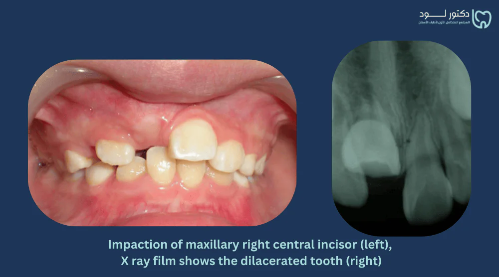 أمراض الفم الشائعة عند الأطفال و malocclusion : علاقة وثيقة - دكتور لود